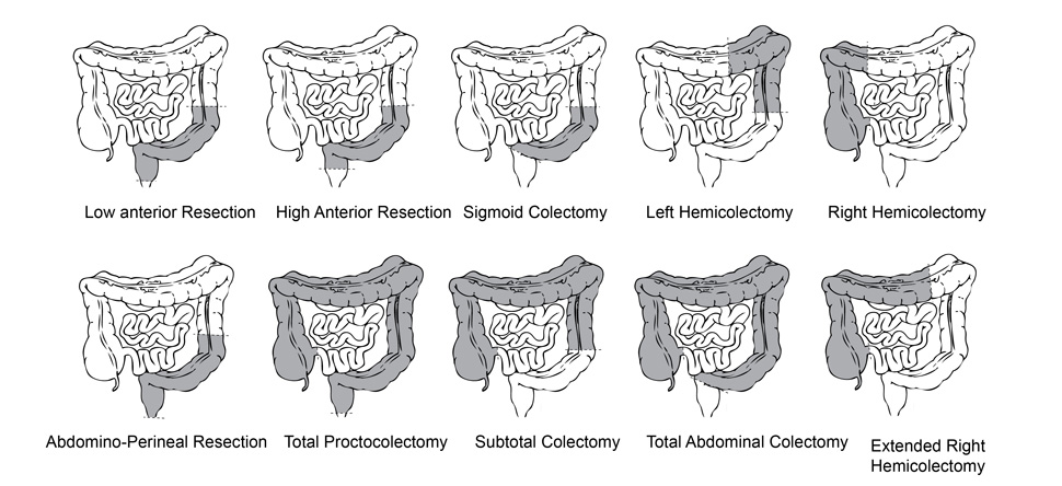 Extended Right Hemicolectomy Blog